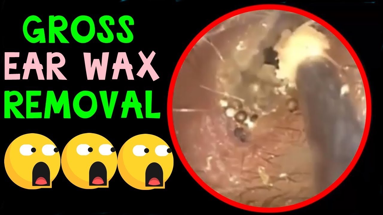 Most Gross Big Earwax Removal From Both Ears - Episode 22 - YouTube