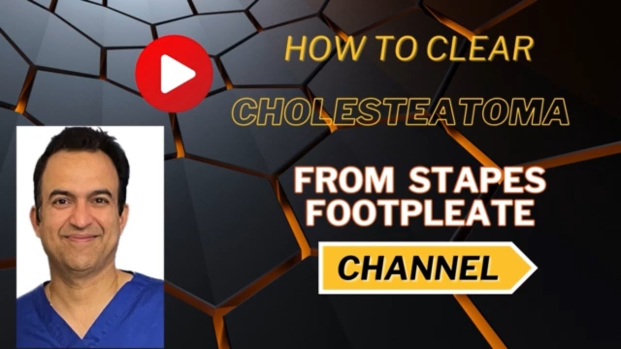 Learn how to clean cholesteatoma from Stapes footplate - YouTube