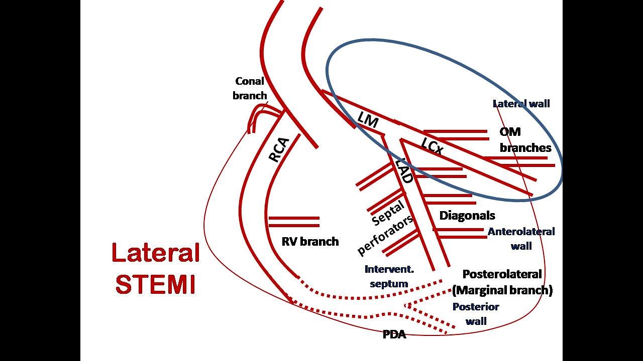 ECG course: Culprit in Lateral STEMI, Dr. Sherif Altoukhy - YouTube