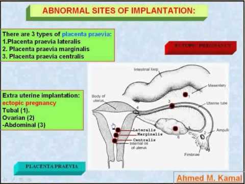 18 Normal and Abnormal Sites of Implantation - YouTube