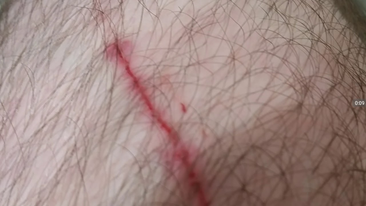 I Woke up With This "Alien Abduction" Scratch After having Vivid Dream ...