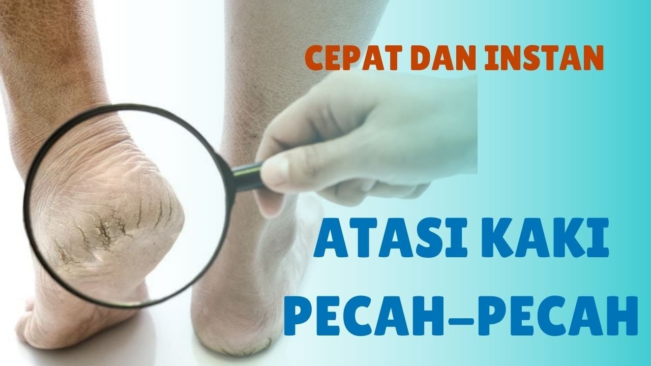 Telapak Kaki Pecah-Pecah? Cara Alami Ini Bisa Jadi Solusi! - YouTube