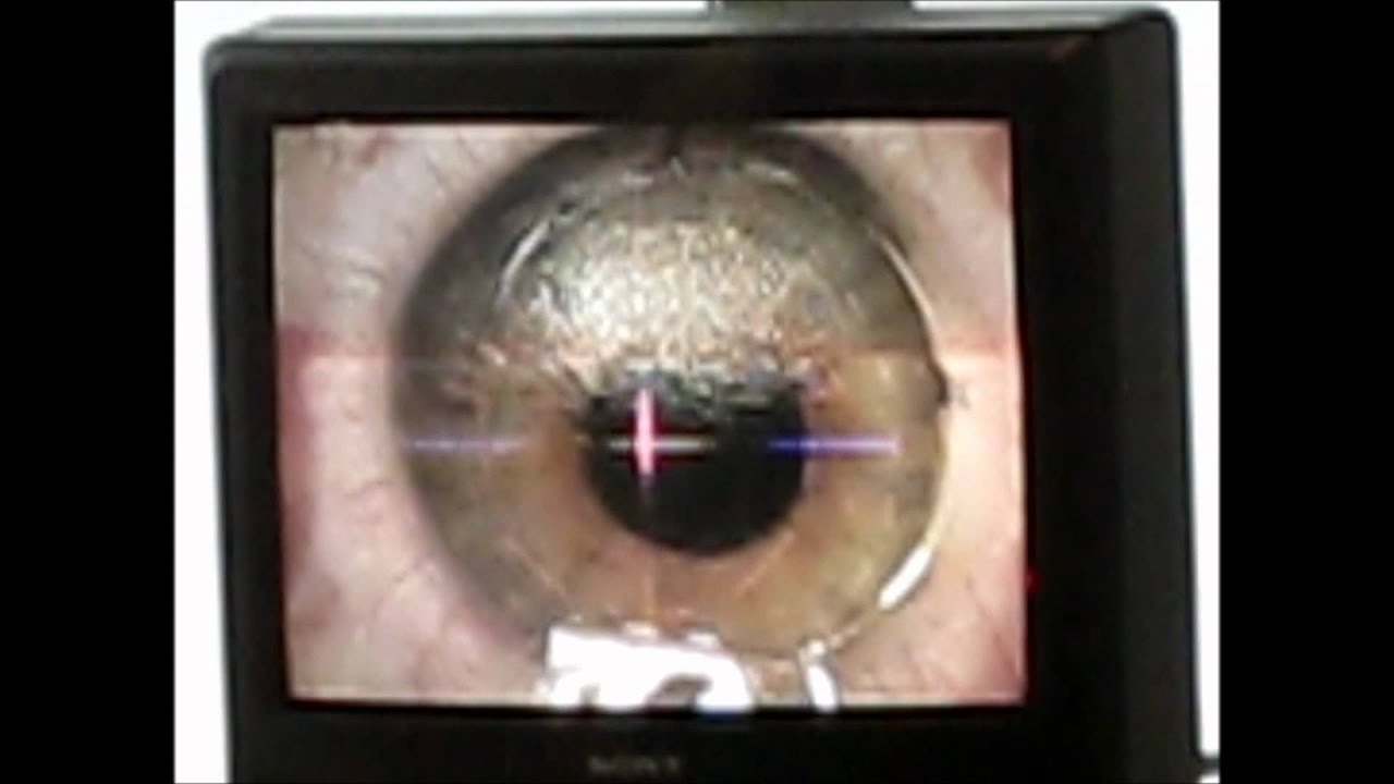 Intralase SBK Eye Surgery - YouTube