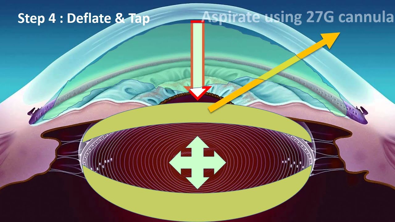 CCC in intumescent cataract step by step guide Dr Sourabh Patwardhan ...