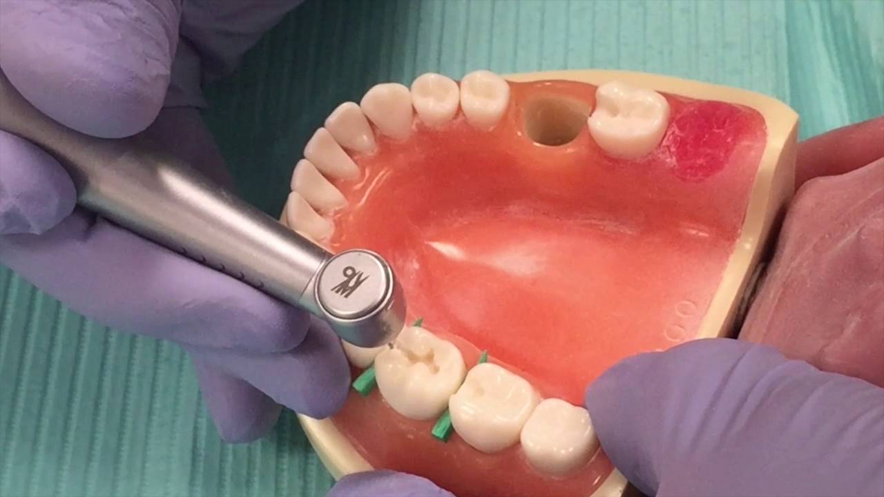 class II preparation - YouTube