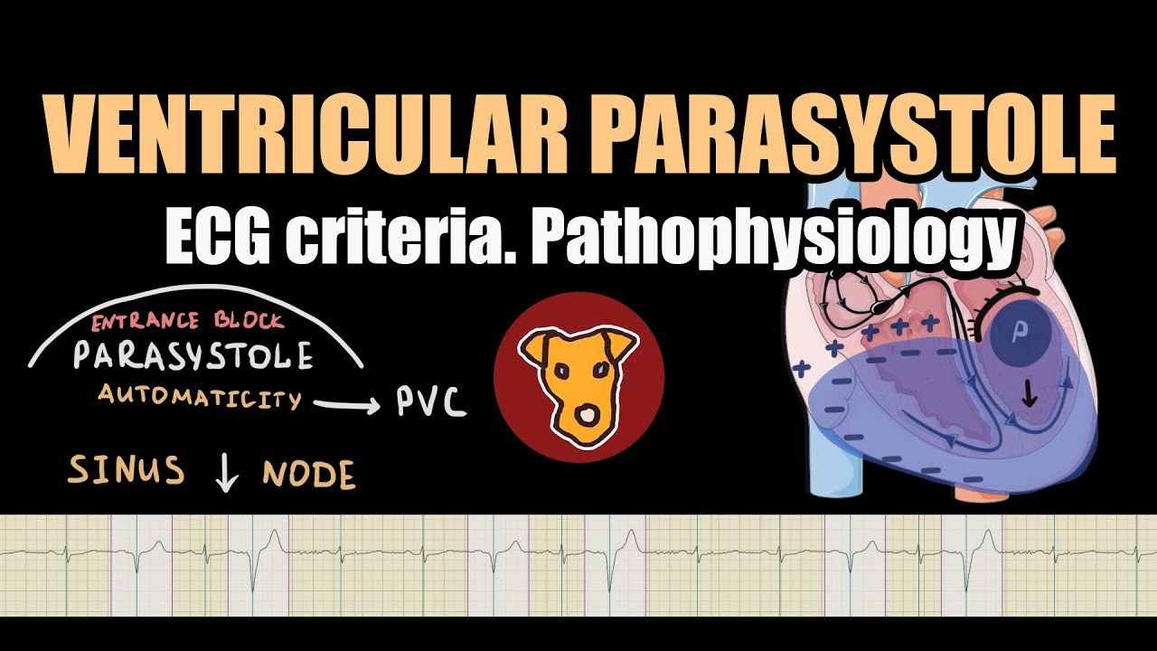 VENTRICULAR PARASYSTOLE ECG Criteria Pathophysiology YouTube ventricular-parasystole-ecg-criteria-pathophysiology-youtube