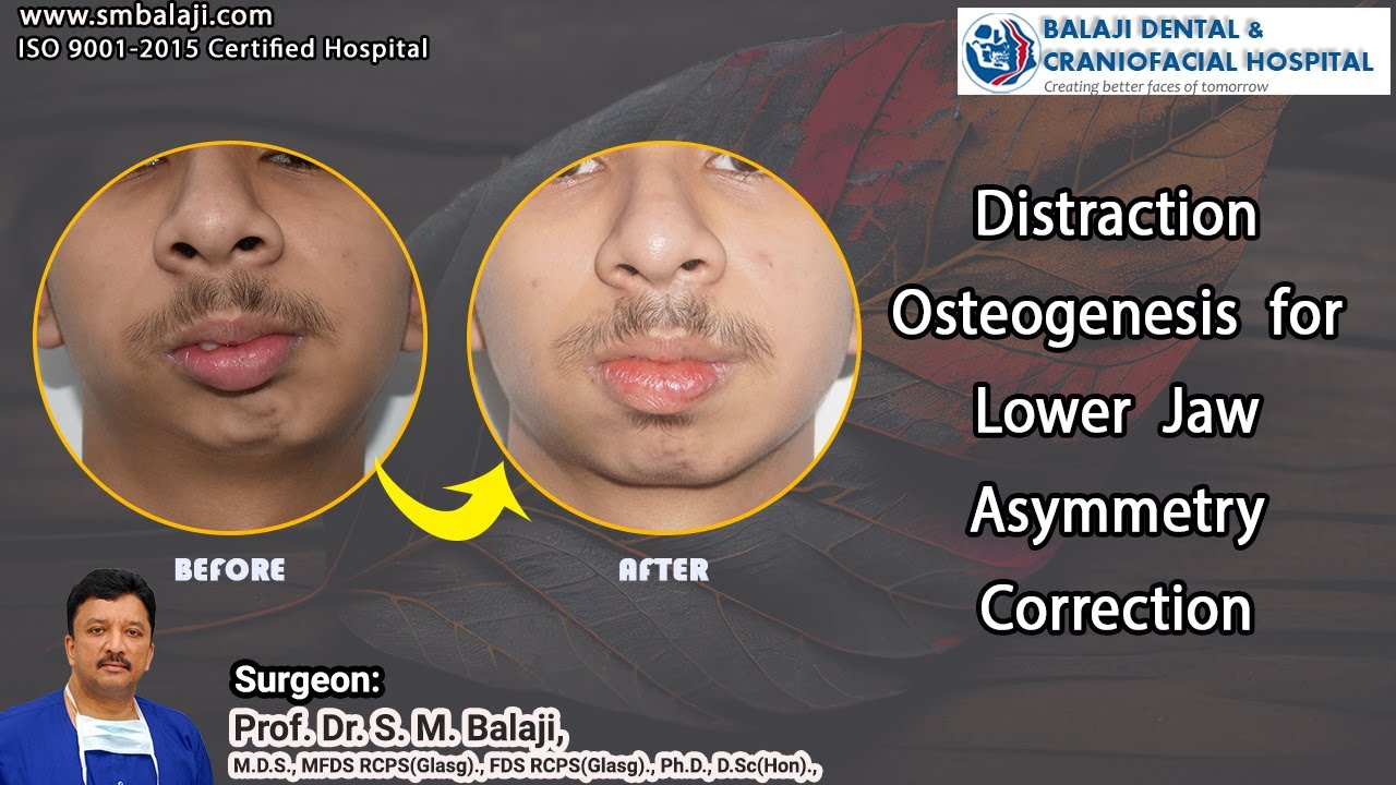 Distraction Osteogenesis for Lower Jaw Asymmetry Correction - YouTube