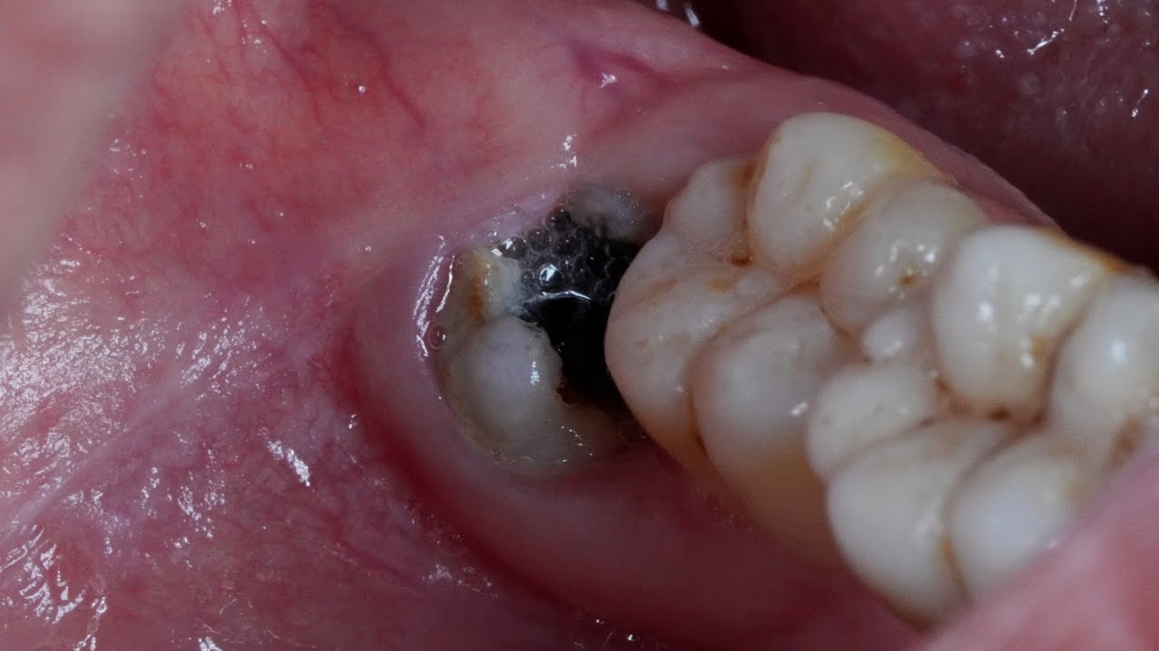 ODONTEKTOMI - GIGI GERAHAM BUNGSU BERLUBANG | Dentist | Dokter Gigi Tri Putra - YouTube