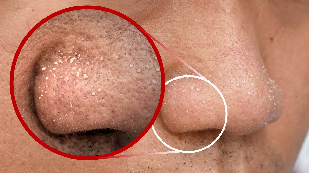 PAANO MATANGGAL ANG BLACKHEADS SA ILONG | 5 MINUTONG NATURAL NA PARAAN ...