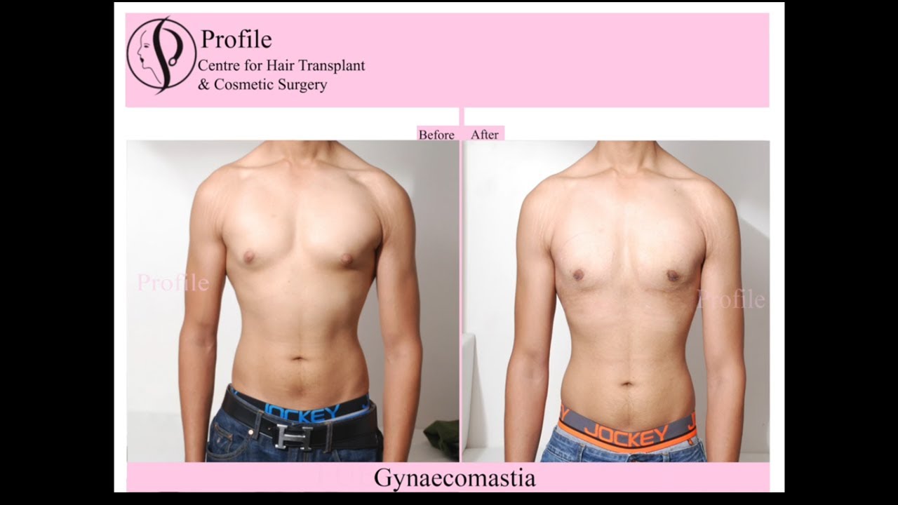 Gynecomastia Surgery in India, Punjab, Ludhiana - YouTube