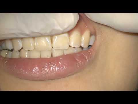 How To Do Fremitus Test In Dentistry