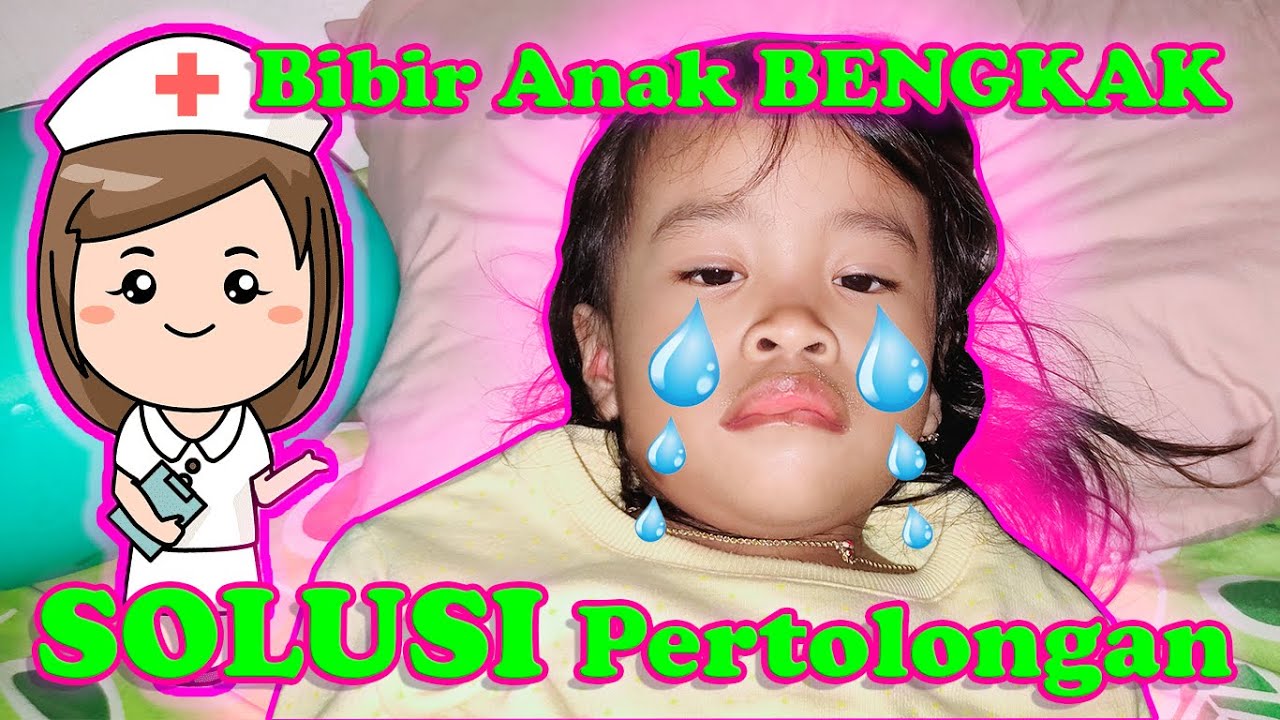 BIBIR ANAK tiba-tiba BENGKAK Saat Tidur I Pertolongan Pertama - YouTube