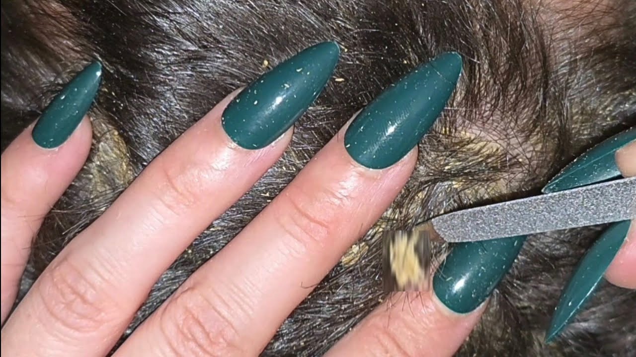 Scalp Therapy ASMR/ Intense Scratching & Gentle Extraction!!! - YouTube