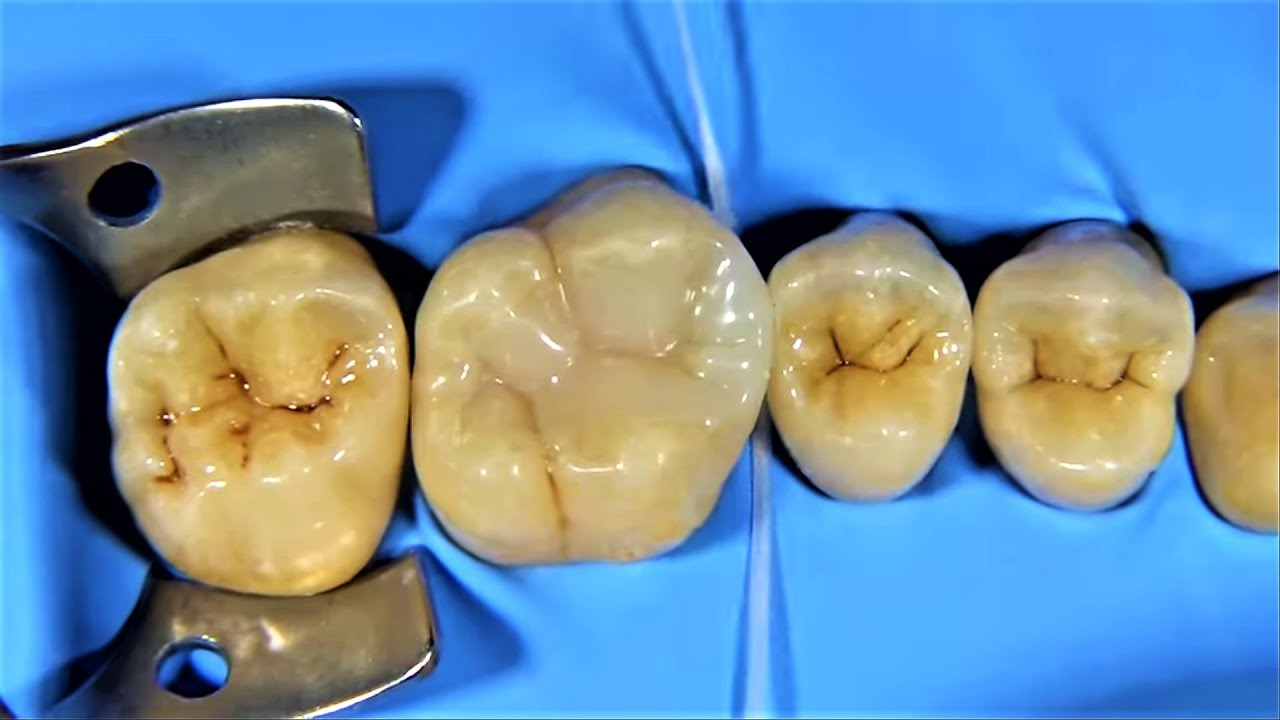 class 2 composite restoration & Cusp Build Up of a Molar #class_2 ...