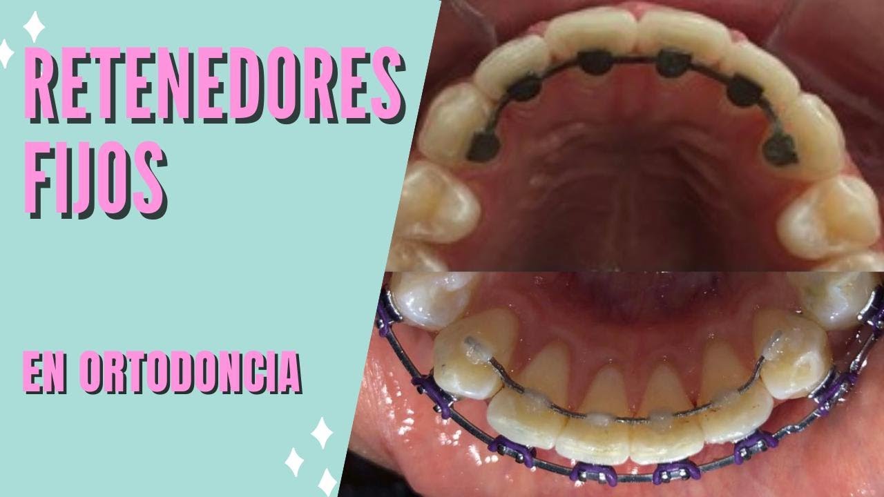 Retenedores Fijos en Ortodoncia - YouTube