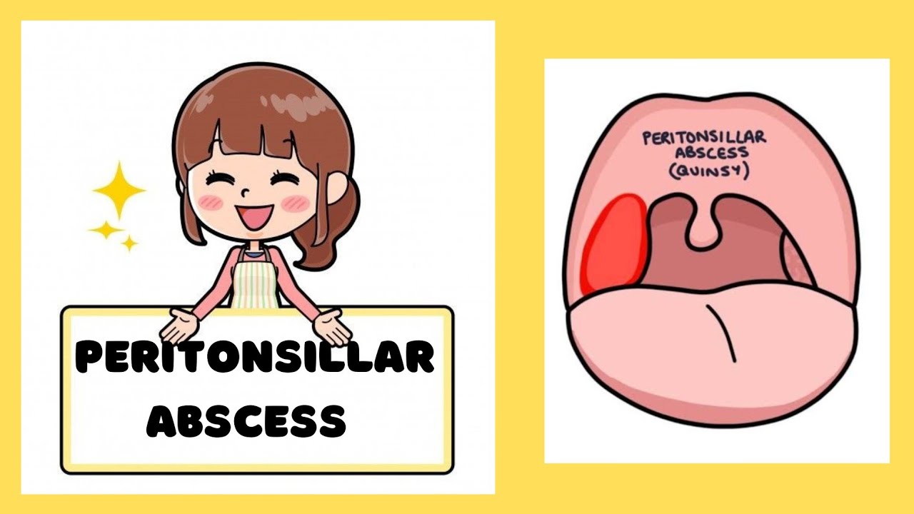PERITONSILLAR ABSCESS #aiapget #mbbs - YouTube