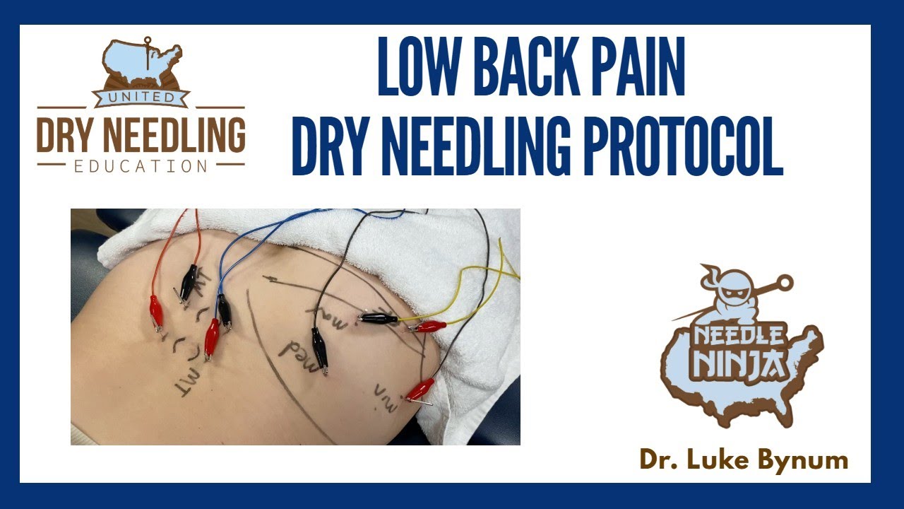 Low Back Pain Dry Needling Treatment Protocol - YouTube