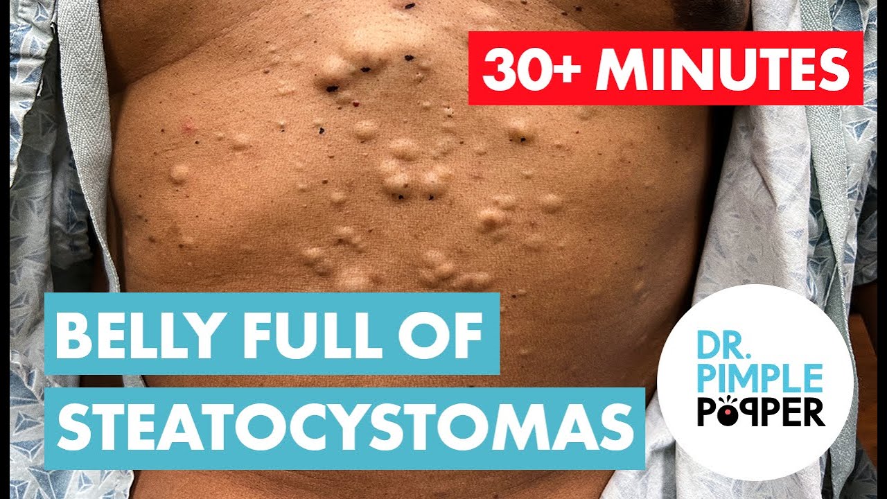 30+ Minutes with A Belly Full of Steatosystomas - YouTube