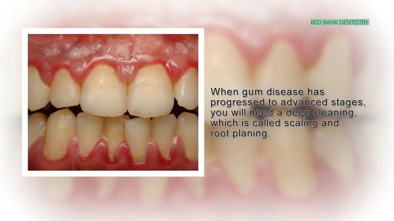 Reverse Gum Disease with Treatment in Red Bank | RedBankDentistry.com ...