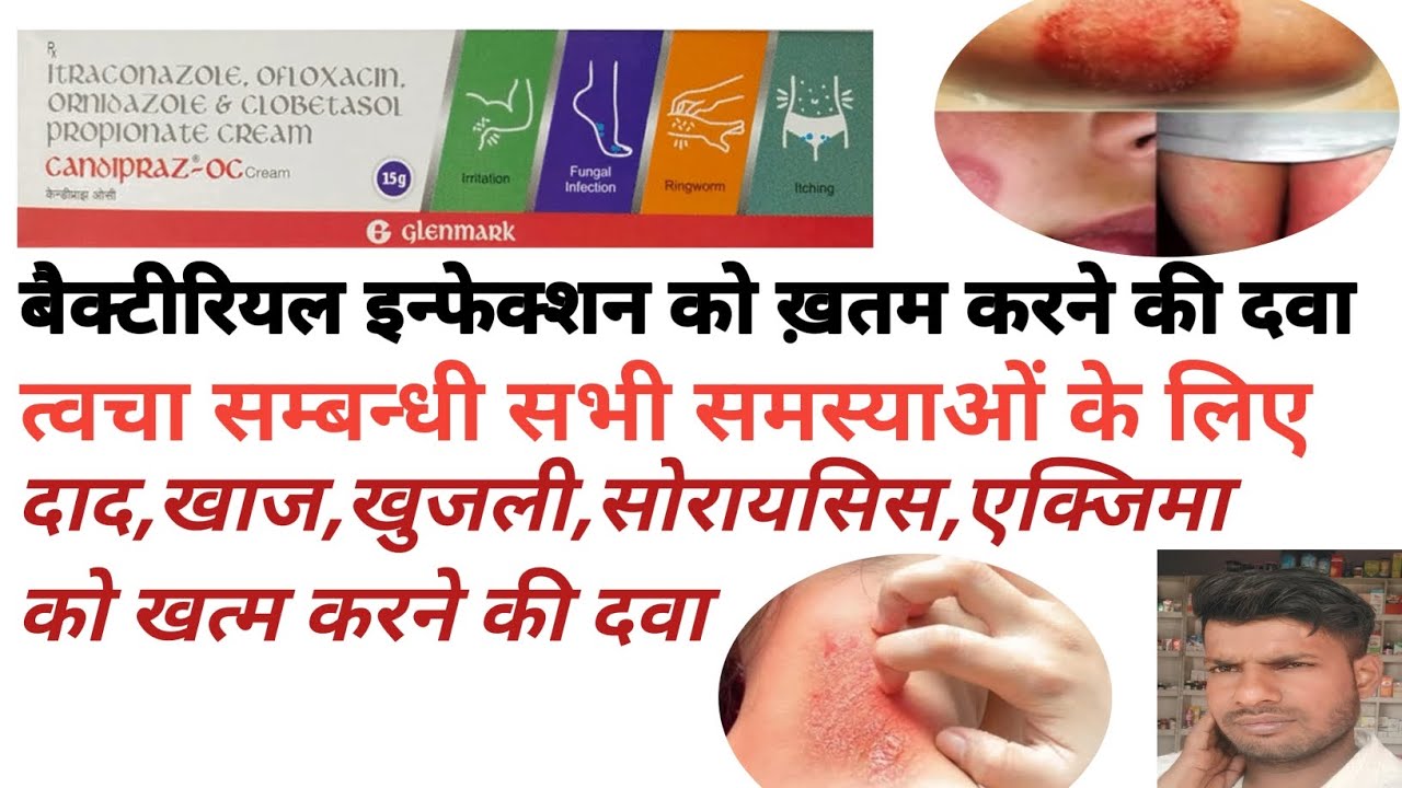 Candipraz-OC Cream | त्वचा सम्बन्धी सभी समस्याओं के लिए | Benefits ...