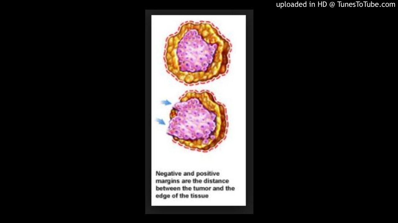 Positive Margins in Breast Cancer - YouTube