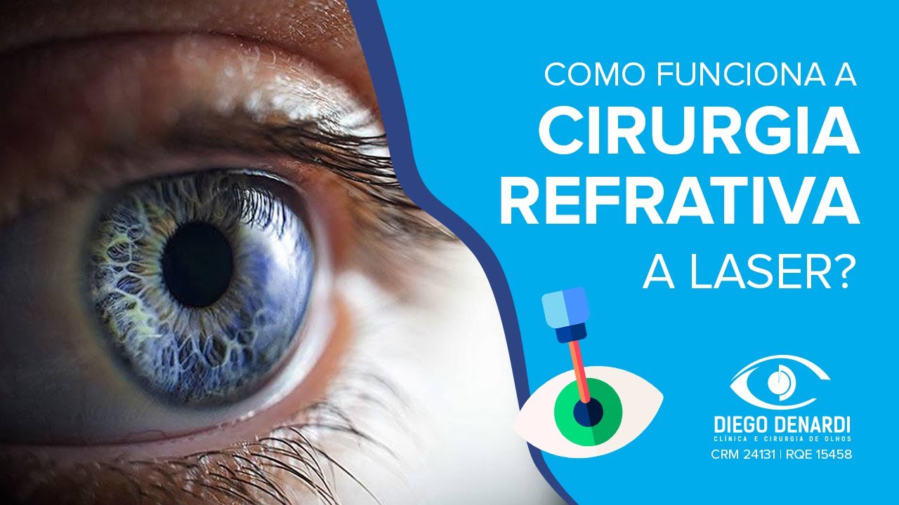 Cirurgia Refrativa Como Funciona A Cirurgia A Laser Nos Olhos 2020
