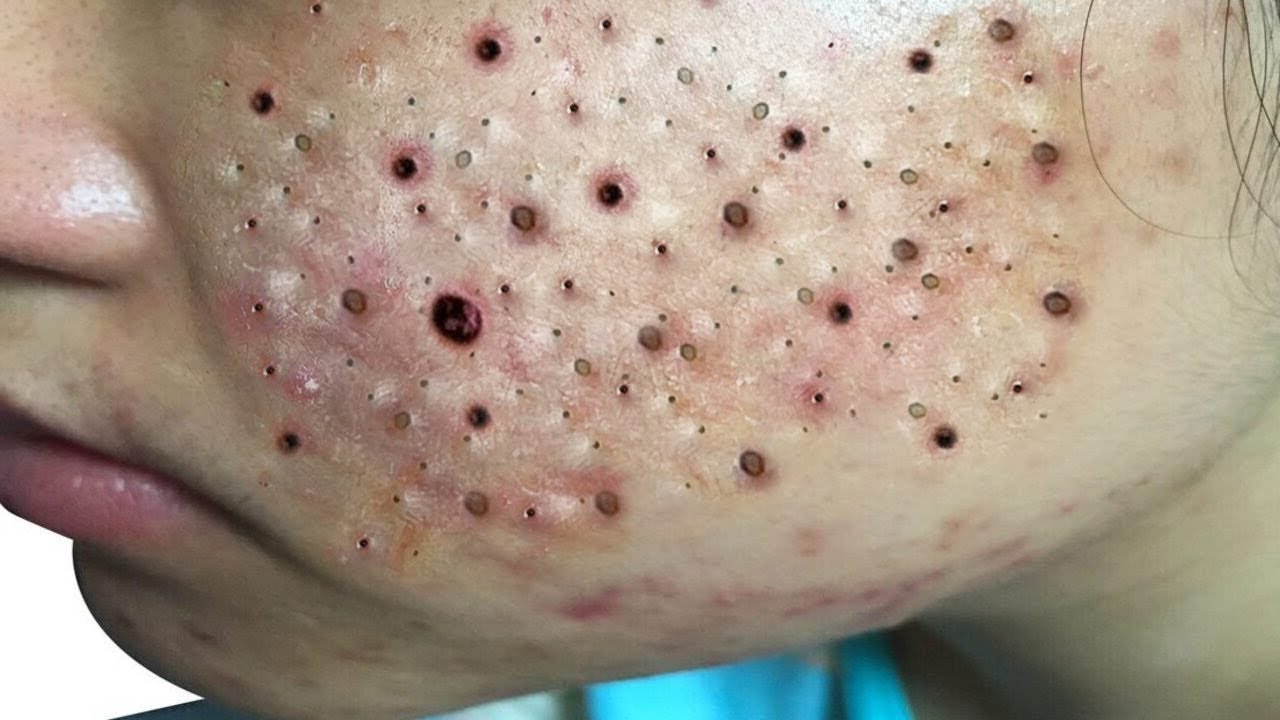 Crazy Satisfying BLACKHEAD REMOVAL/Blackhead Removal - YouTube