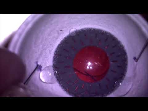 Yamane technique on SimulEYE model