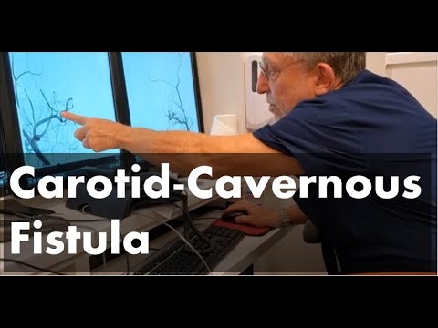 Neuroangiography by Dr. Alejandro Berenstein - Carotid-Cavernous ...