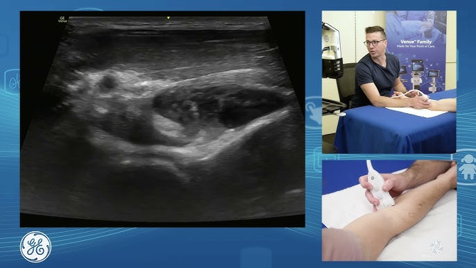 2020 Ultrasound In Distal Biceps Tendon Injuries Youtube