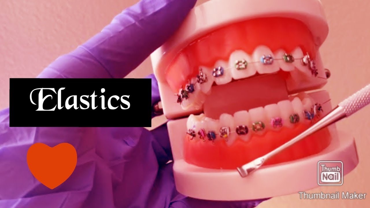 Elastics/Rubber Bands | Braces Tip 101 - YouTube