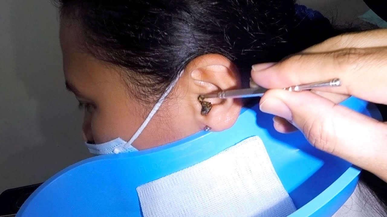 Removing Huge Woman's Earwax Using An Ear Curette - YouTube
