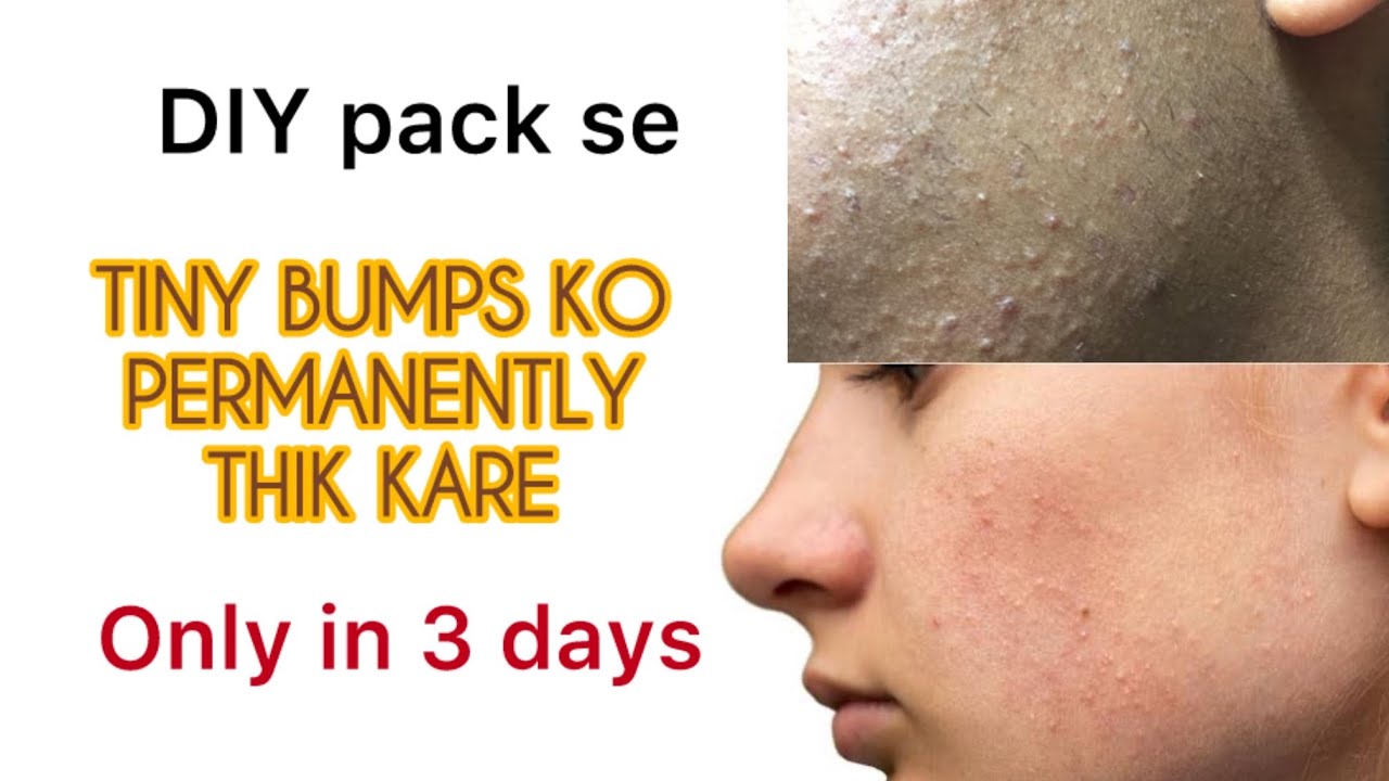 How to treat tiny bumps Permanently 😳 💯| tiny bumps removal pack # ...