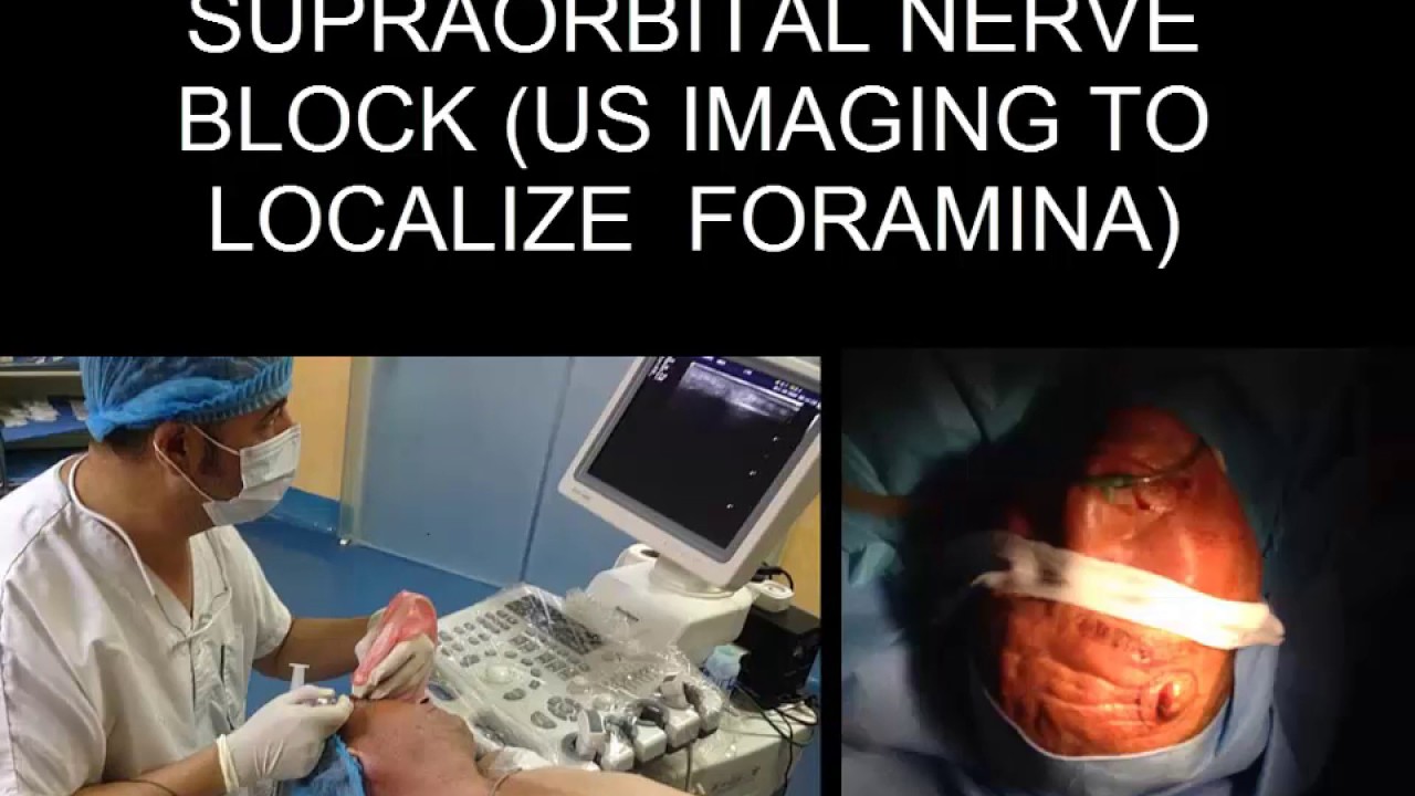 ULTRASOUND GUIDED SUPRAORBITAL NERVE BLOCK ULTRASOUND IMAGING TO ...