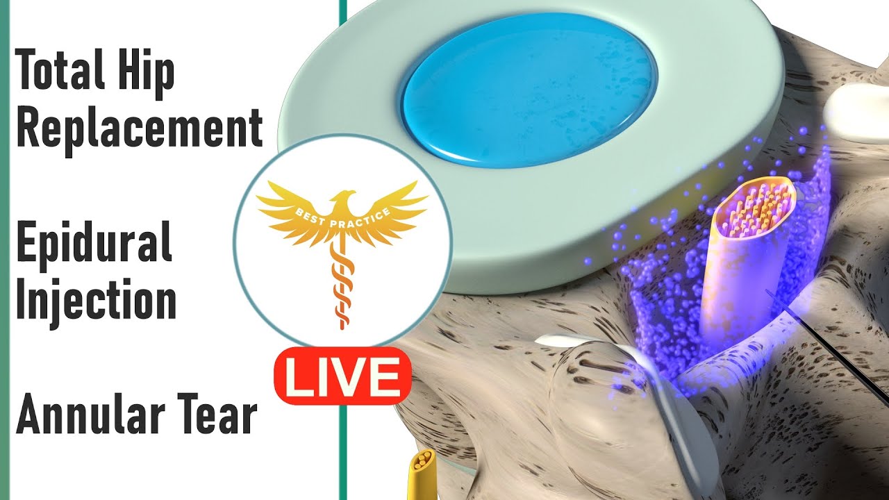 Neurosurgeon goes into detail about Total Hip Replacement, Epidural ...