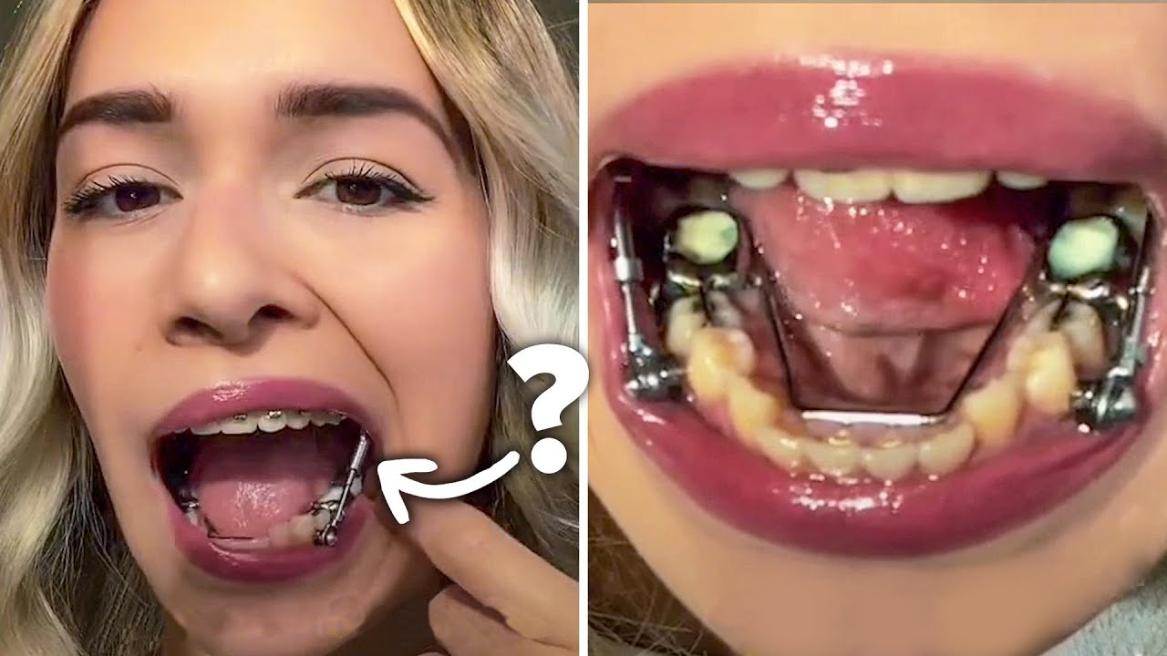 Eating With Metal Rods In My Mouth - YouTube