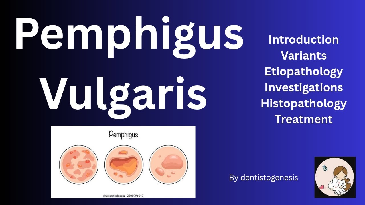 Pemphigus vulgaris | oral pathology | 3rd year BDS - YouTube