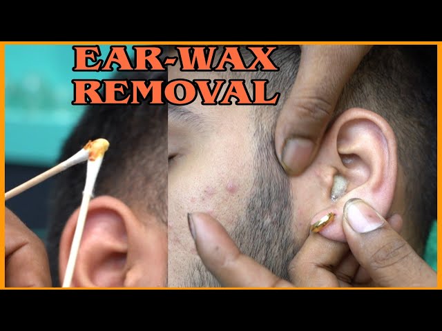 Most Disgusting Ear Wax Ear Wax Removal – The Best Ways To Do It In