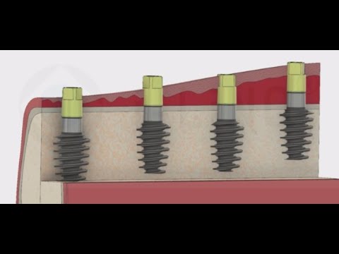 4) i-LiNQ İmplant // İmplantı Konumlandırma - YouTube