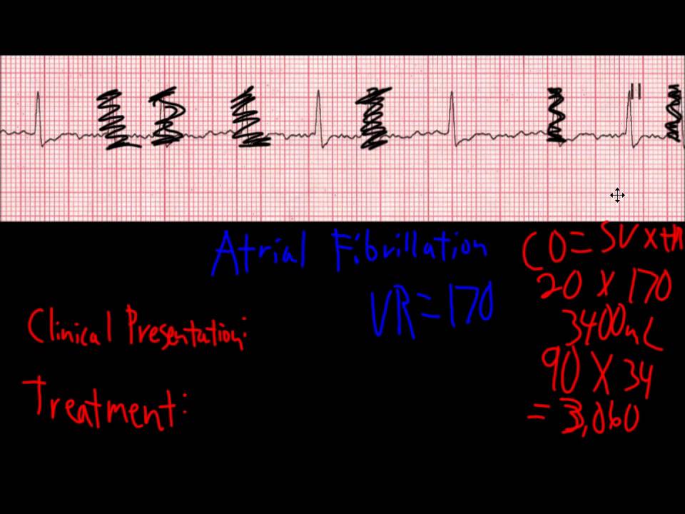 Atrial Fibrillation and Atrial Flutter - YouTube
