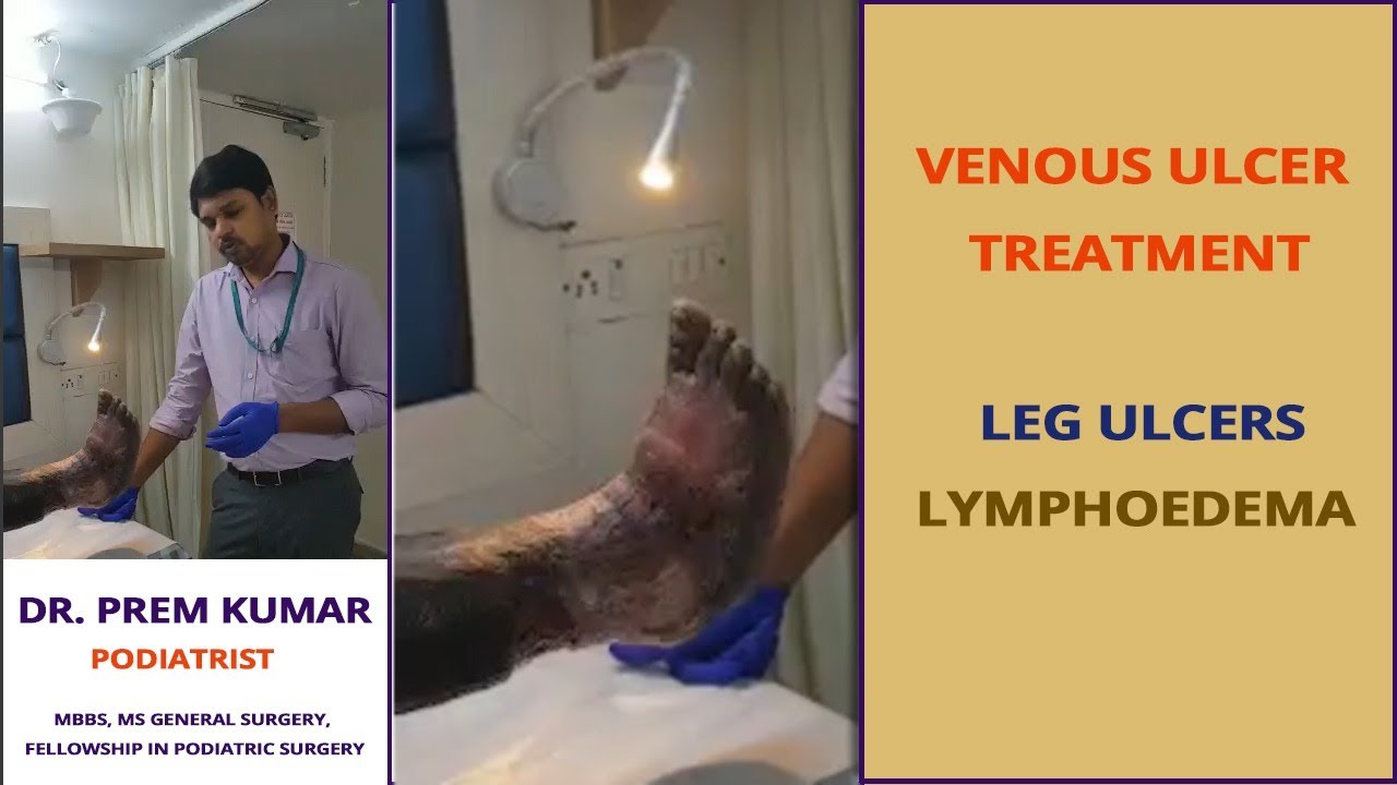 DVT Leg Ulcer, Varicose Ulcer Treatment, and Lymphoedema at Dr. Prem's ...
