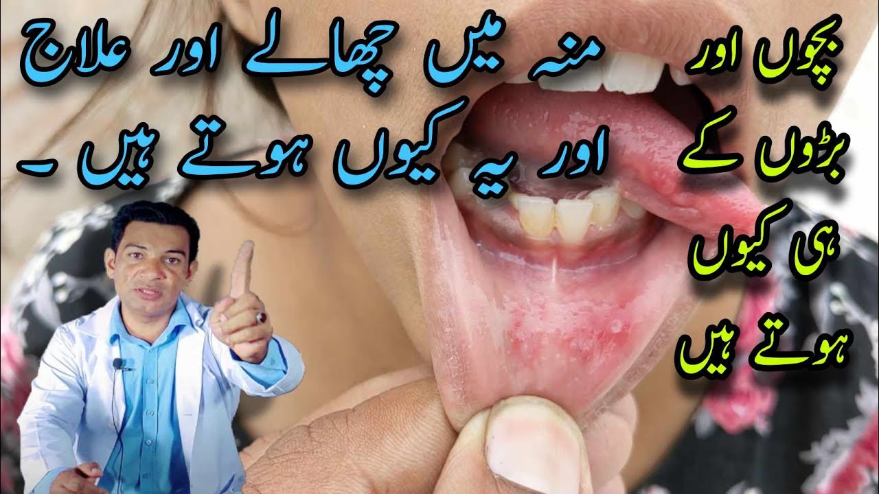 mou k chalon ka ilaj | mouth ulcer | moun main shalon ka ilaj | munh ke ...