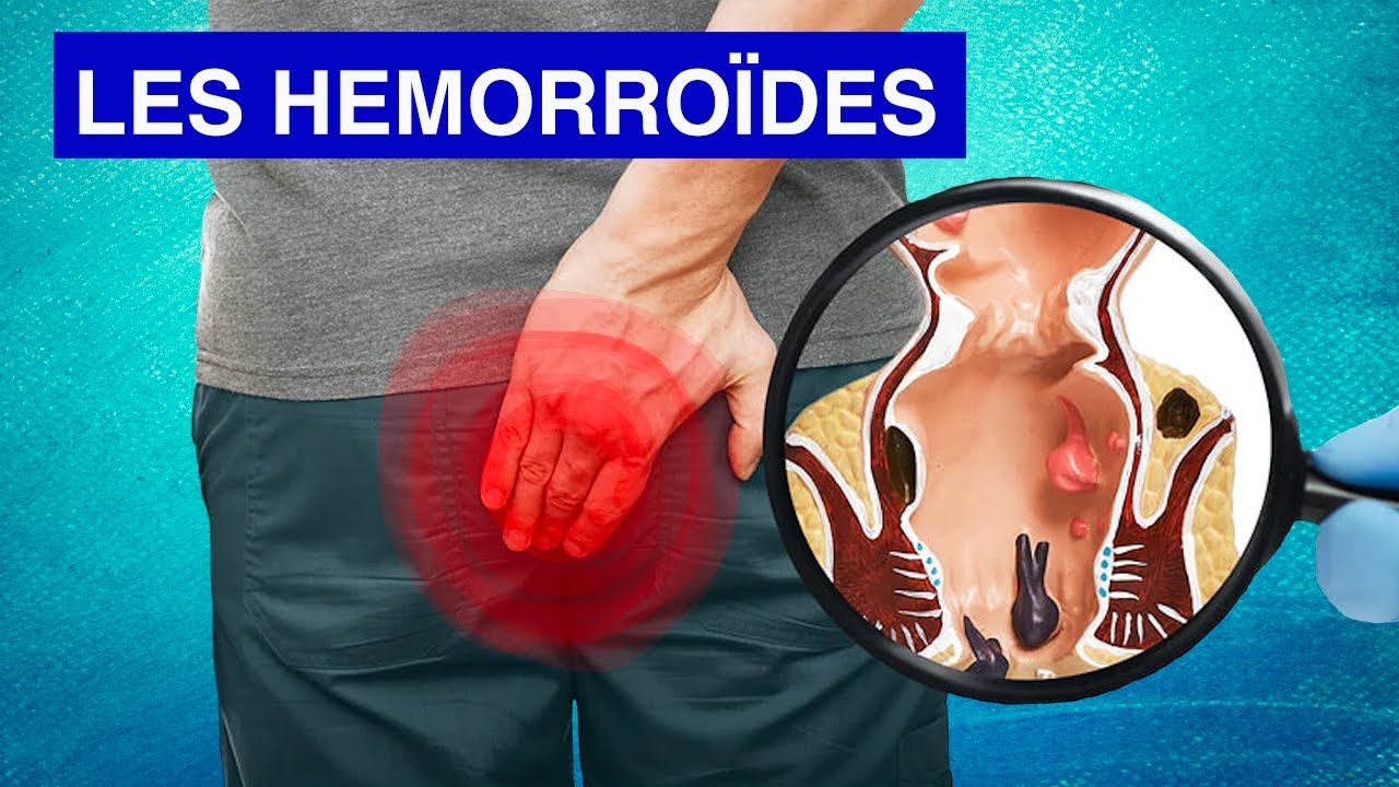 LES HEMORROÏDES : Symptômes, diagnostic et traitements - YouTube