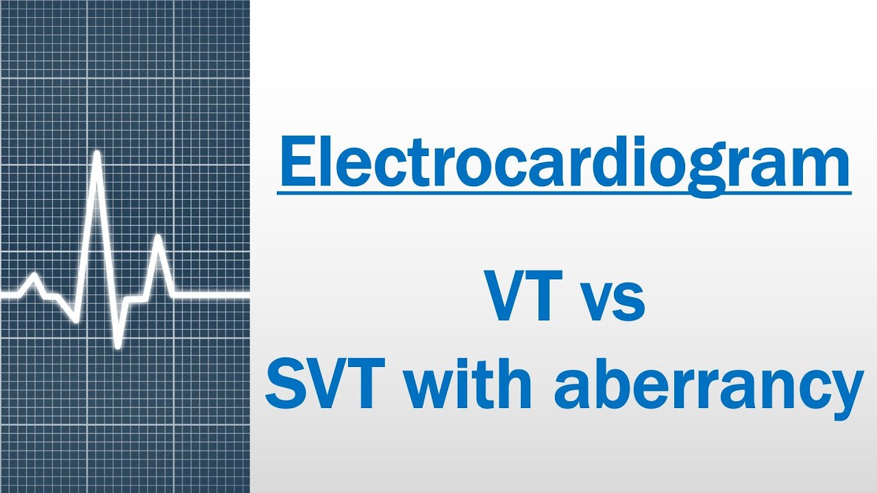 VT versus SVT with aberrancy [Electrocardiogram] - YouTube