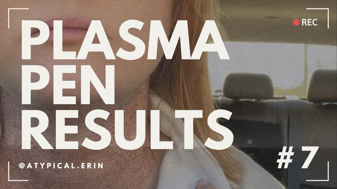 Plasma Pen Experience - Getting Plasma Pen, a Daily Video Journal and ...