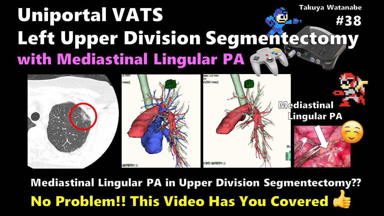 No.38 Uniportal VATS Left Upper Division Segmentectomy with Mediastinal ...
