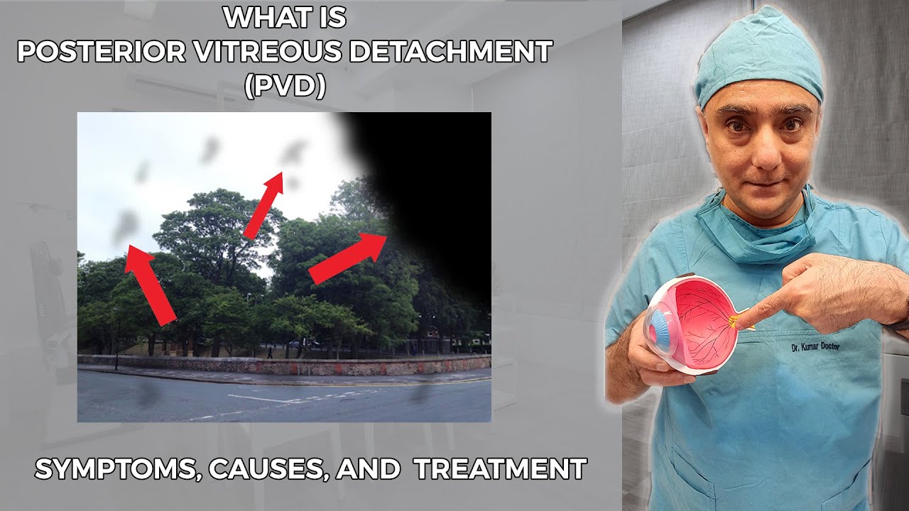 What is Posterior Vitreous Detachment (PVD): Symptoms, Causes, and Treatment - YouTube