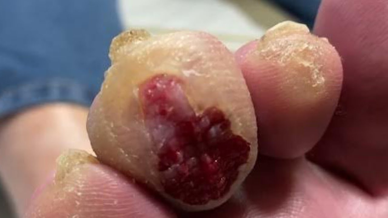 Follow up of toe abscess - YouTube