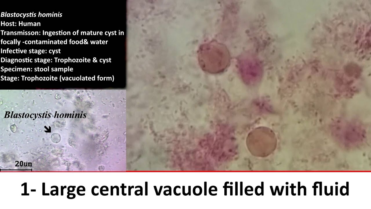 5- Pratical Parasitology - Blastocystis Hominis - Trophozoite Stage ...
