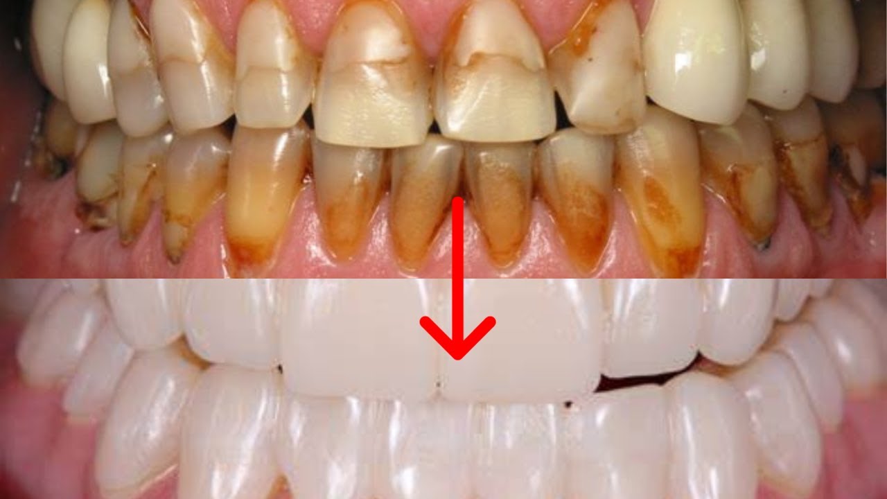 Instant Teeth Whitening: Astalavista to Yellow Stains and Tartar ...